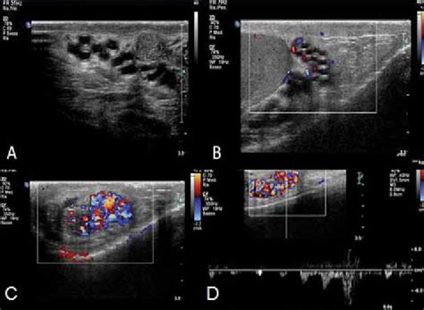 Grey Scale Ultrasound Identifies Multiple Dilated Ducts A Colour
