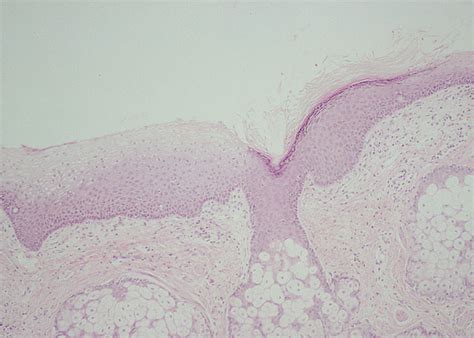 Reproductive Pathology Renaissance School Of Medicine At Stony Brook University