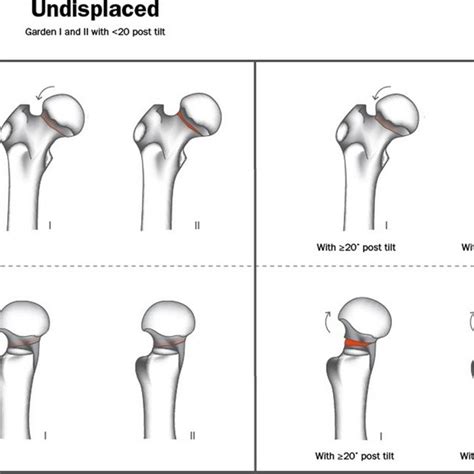 Proposed Modified Garden Classification Of Undisplaced And Displaced