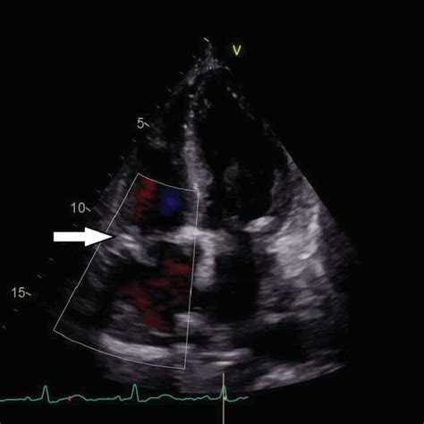 Doppler Echocardiogram Of The Preoperative Tricuspid Valve Showing