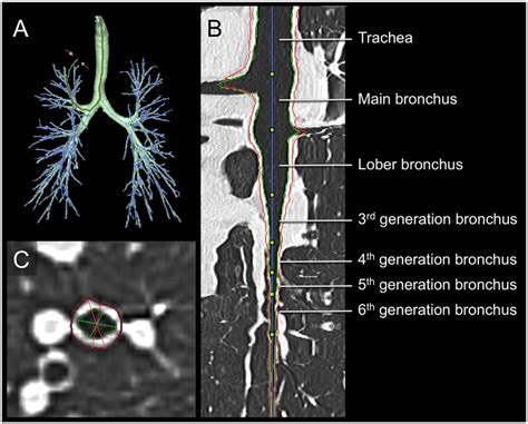 Three Dimensional Ct Analysis Of The Airway A The Image Of The
