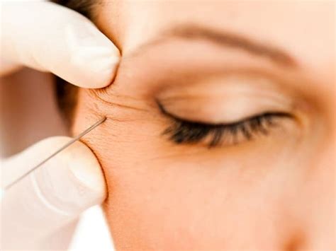 Botulinum Toxin For Droopy Eyelids Treatment Maylips