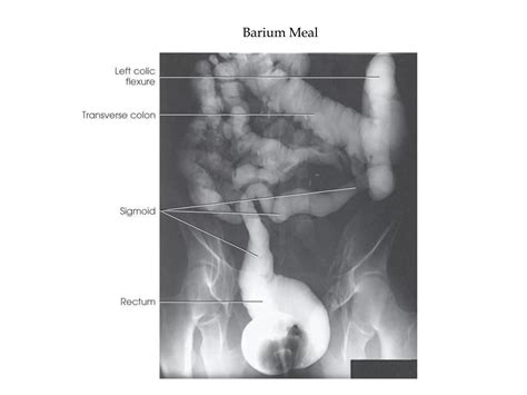 Gastro Intestinal Tract Abdomen Radiology Ppt
