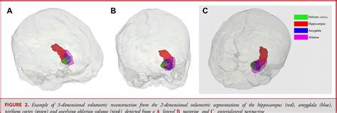 Figure From Piriform Cortex Ablation Volume Is Associated With Seizure Outcome In Mesial