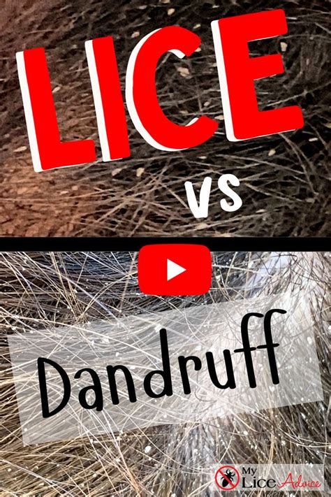 Difference Between Lice Eggs And Dandruff
