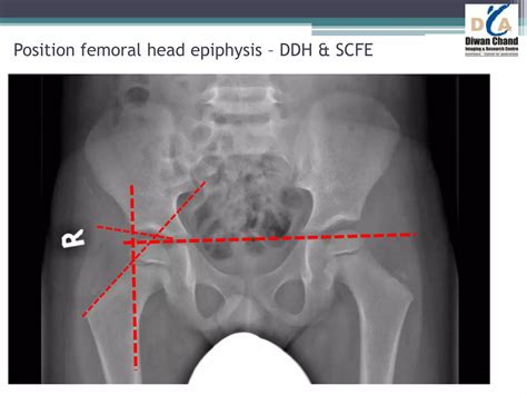 Radiological Evaluation Of Hip Pn Ppt