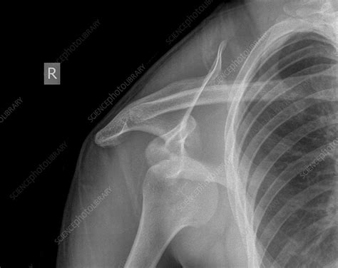Shoulder Bone Dislocation Stock Image C0197267 Science Photo Library