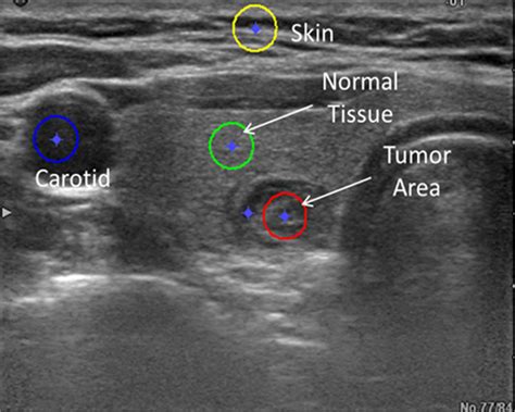 Abnormal Thyroid Ultrasound Images