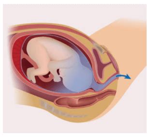 PROM And PPROM Exams Naxlex Nursing