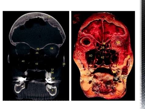 Cbctinterpretation Cbct Applications And Readingpptx