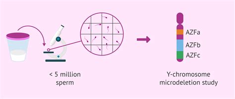 How Is Male Infertility Caused By Y Chromosome Microdeletions