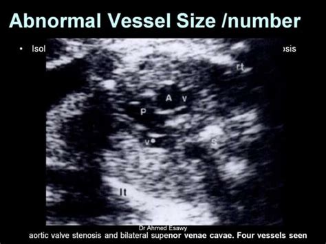 Fetal Echo Three Vessel Trachea View 3 Vt Dr Ahmed Esawy