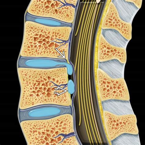What Is Degenerative Disc Disease At L5 S1 At Alicia Brinton Blog
