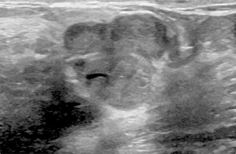 Ultrasound Of Left Breast Showing Multilobulated Lesion Bi Rads 4