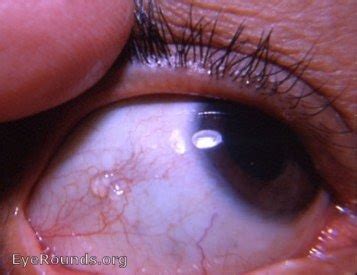Conjunctiva Anatomy Flashcards Quizlet
