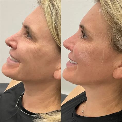 Skinvive Before And After Before After Journey