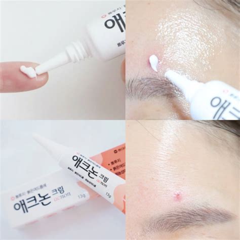 화농성 여드름 원인 관리방법 연고 애크논 크림 효과 네이버 블로그