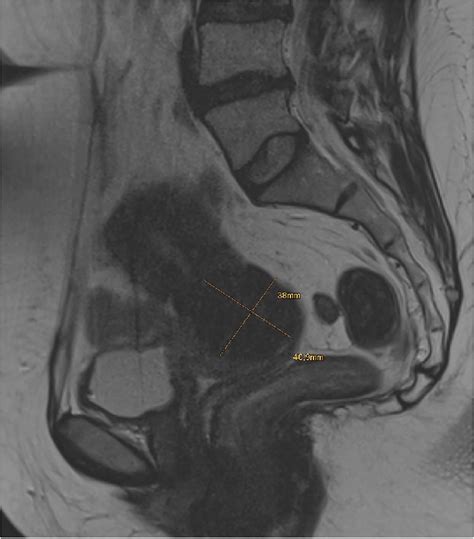 Sagittal T2 Weighted Mri Of The Pelvis Showing A 38 × 40 Cm Mass