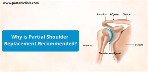 Partial Shoulder Replacement Joint Replacement Surgeon In Jaipur