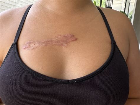 My Keloid Treatment Journey Using Kenalog Schimiggy Reviews