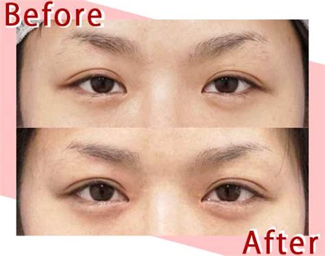 【症例写真で医師が解説】目を大きく華やかにできる目頭切開の効果をビフォーアフター写真で解説