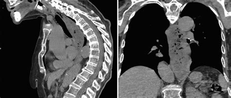 1a And 1b Non Contrast Computed Tomography Scan Of The Chest Showing