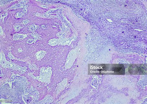 Conventional Highgrade Osteosarcoma Is Typically High Grade And Originates In The Intramedullary