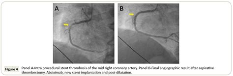Simultaneous Massive Coronary Air Embolism And Intraprocedural S