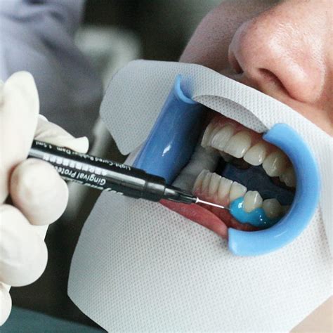 Beyond Blueseal Gingival Protection 5 Pack Dental Care Gum Protector