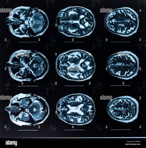 Human Brain Magnetic Resonance Imaging MRI Scans Stock Photo Alamy