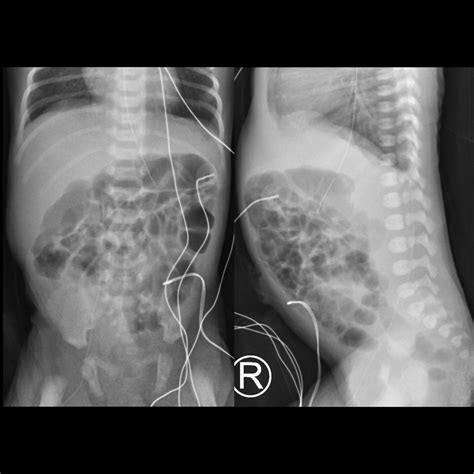 Premature Newborn After Picc Placement Pediatric Radiology Case
