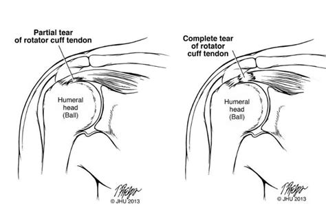 Supraspinatus Tear Mri