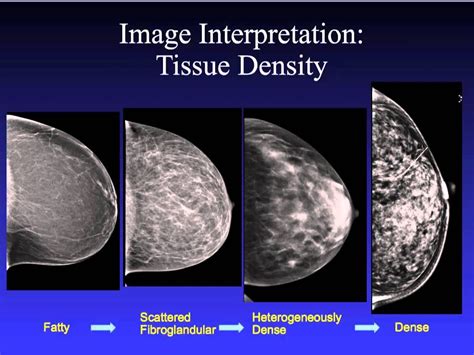 Breast Radiology Center Mammography Breast Mri