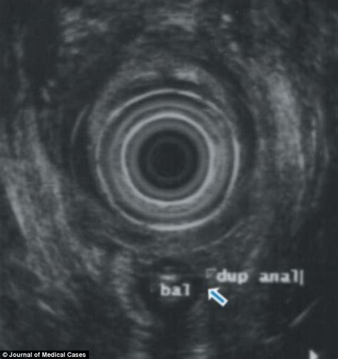 Doctors Discover A Portuguese Woman Has 2 Anuses Daily Mail Online