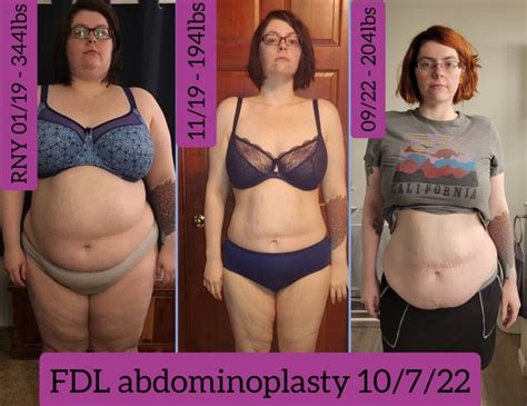 Getting My Tummy Tuck In Two Weeks Finally Taking Some Before