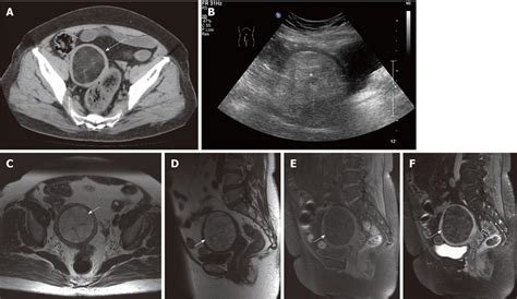 画像 Heterogeneous Lesion In Uterus Meaning 253204 What Does A