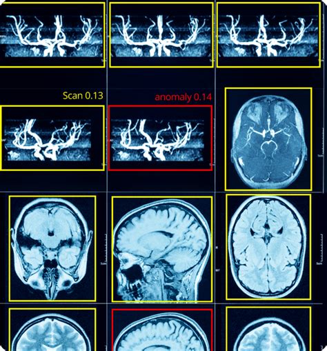 Anomaly Detection In Medical Image Analysis Imagevisionai