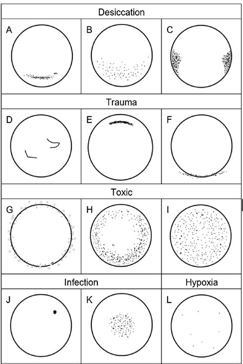 Schematic Representation Of Various Patterns Of Corneal Fluorescein