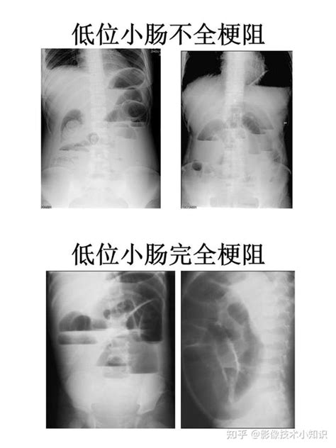 肠梗阻影像诊断 知乎