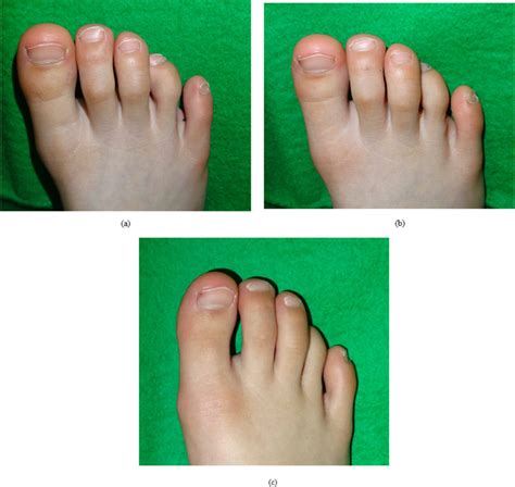 Curly Toes Czyli Nachodzące Się Palce Stóp Na Siebie Fizjostópki