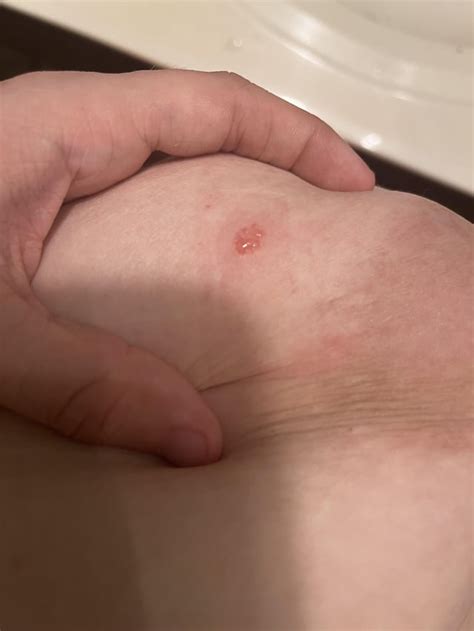 21f Small Coin Shaped Lesions History Of Eczemadermatitis Treated