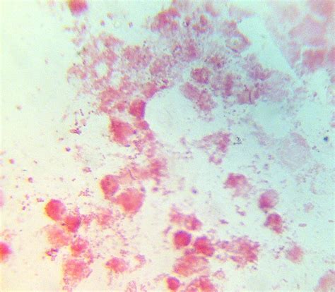 The Urgent Threat Of Drug Resistant Gonorrhea Pathadvantage