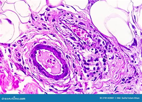 Photomicrograph Of Granulomatous Tissue Histology Royalty Free Stock