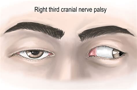 What Cranial Nerve Palsy Causes Third Nerve Palsy Causes Symptoms