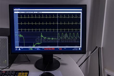 Denizli Turkey 28 February 2024 Monitor Screen With Vital Sign And