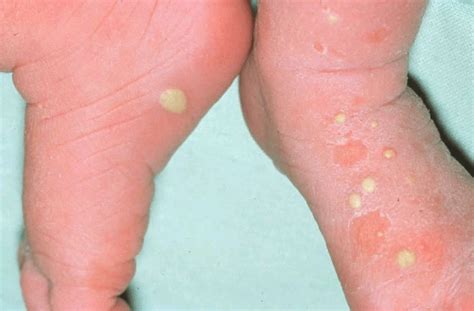 Neonatal Dermatology The Benign Conditions