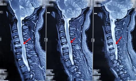 病例分享：因颈背部疼痛、上臂抽疼，检查出颈5椎体结核 微医（挂号网）