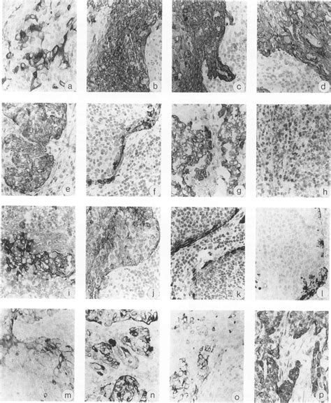 Immunoperoxidase Staining Pattern Offirozen Sectionsfrom Large Cell Download Scientific Diagram