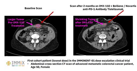 Immix Biopharma Announces Early Positive Imx 110 Interim