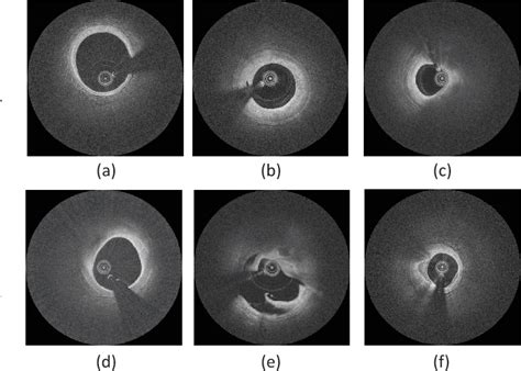 Figure 1 From Automatic Image Classification In Intravascular Optical Coherence Tomography